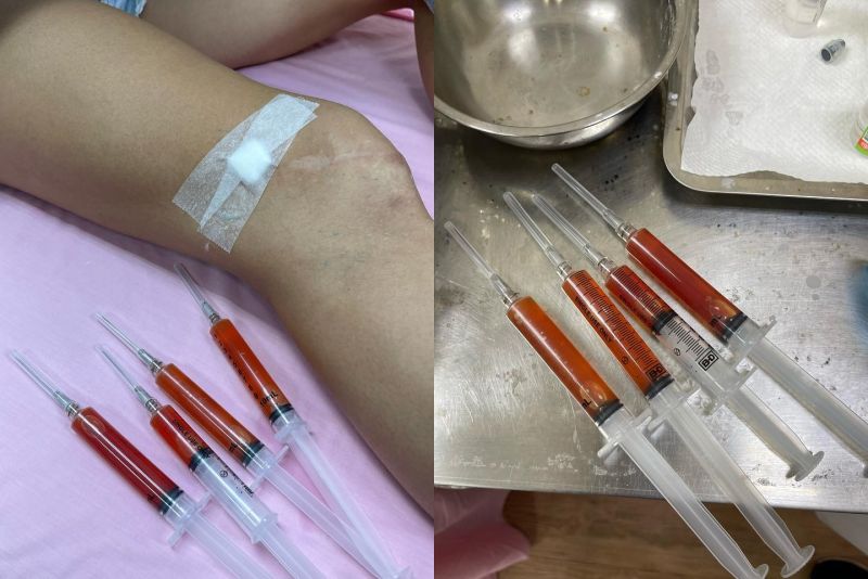 《全明星》壯壯曝膝蓋抽血驚悚照 巫苡萱心疼：撐了半年 | beanfun!