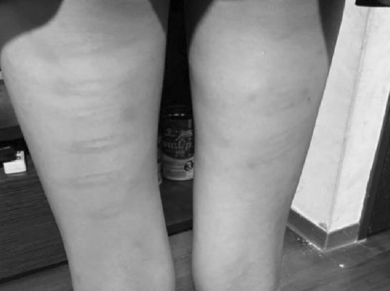 國小女童考試第5名 遭父體罰狂抽腿部PO網 | beanfun!